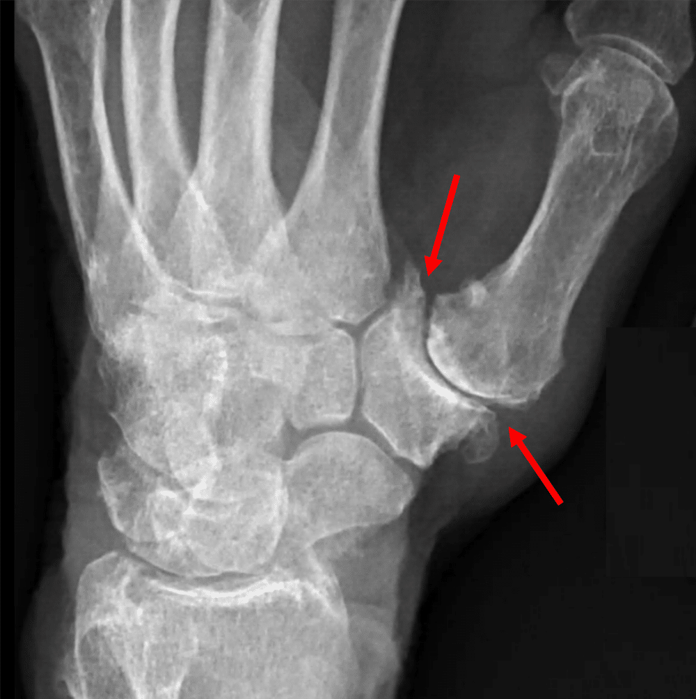 Base Of Thumb Arthritis The ArmDoc Base Of Thumb Arthritis The ArmDoc