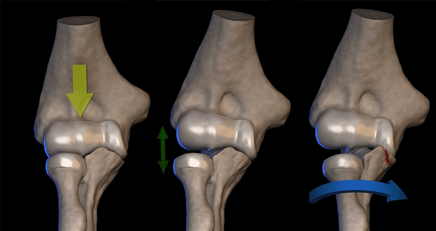 The ArmDoc - Elbow Instability