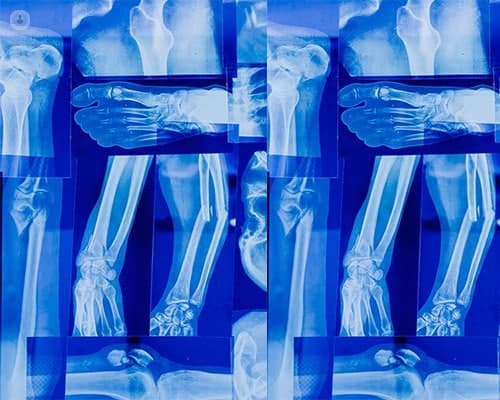 Complex bone fractures explained – The ArmDoc