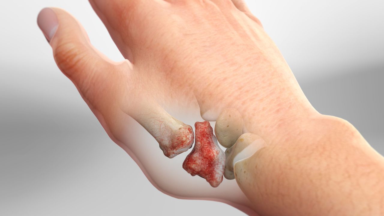 The ArmDoc - Base of thumb arthritis