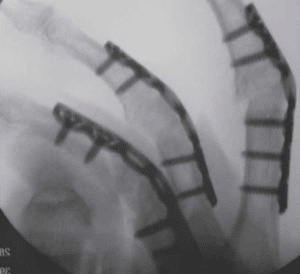 Finger fusion - The ArmDoc