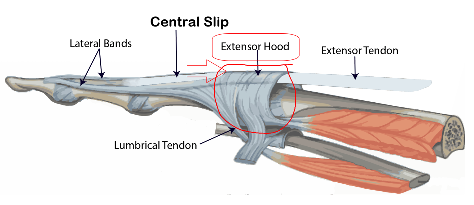The ArmDoc - Traumatic Extensor Hood Rupture