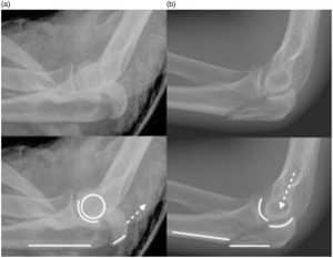 Elbow Fractures - An olecranon fracture - The ArmDoc