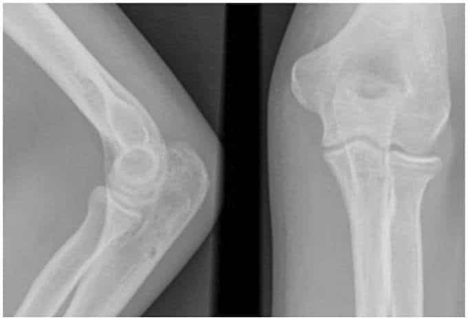 Elbow Fractures - An olecranon fracture - The ArmDoc
