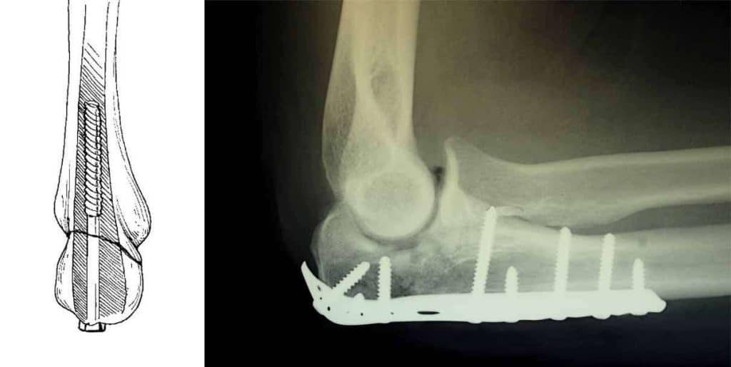 Elbow Fractures - An olecranon fracture - The ArmDoc