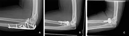 Elbow Fractures - An olecranon fracture - The ArmDoc