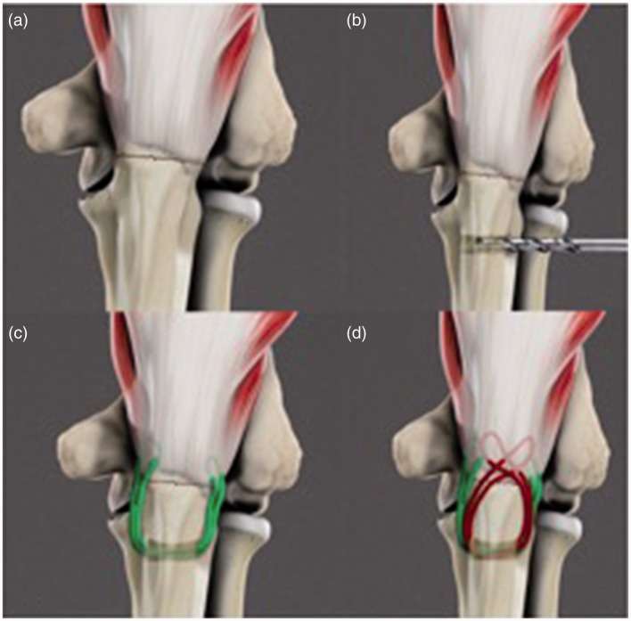 Elbow Fractures - An olecranon fracture - The ArmDoc