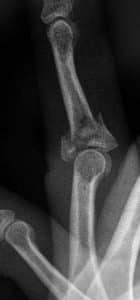 Phalangeal fractures and dislocations - The ArmDoc