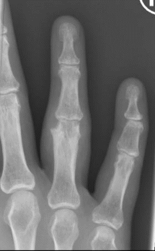Phalangeal fractures and dislocations - The ArmDoc