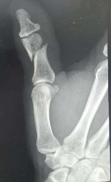 Phalangeal fractures and dislocations - The ArmDoc