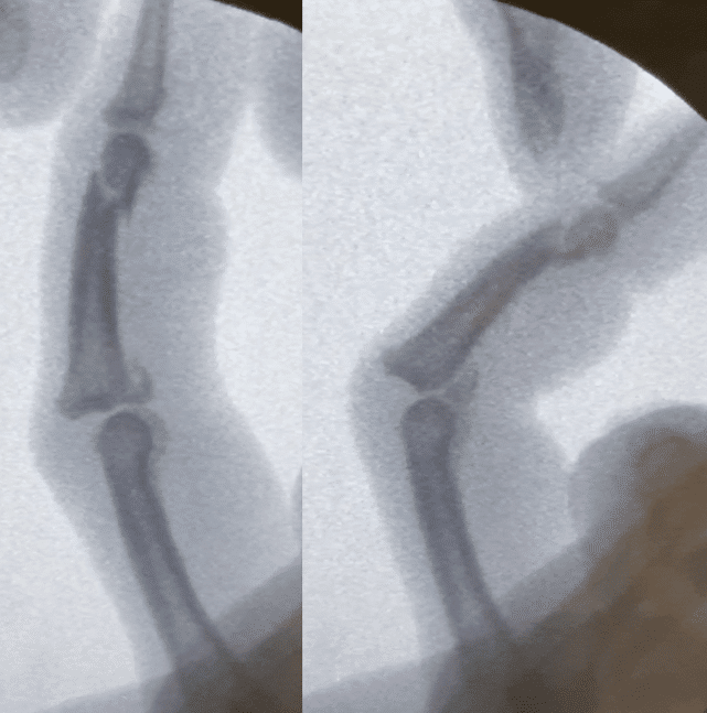 Phalangeal fractures and dislocations - The ArmDoc