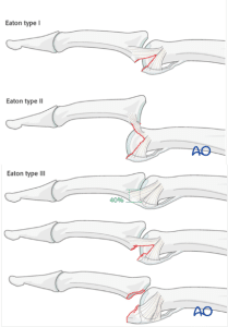 Phalangeal fractures and dislocations - The ArmDoc