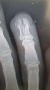 Phalangeal fractures and dislocations - The ArmDoc