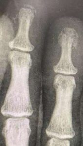 Phalangeal fractures and dislocations - The ArmDoc