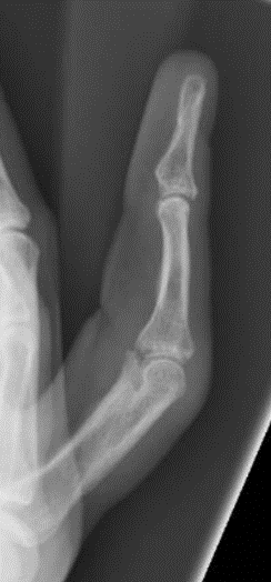 Phalangeal fractures and dislocations - The ArmDoc
