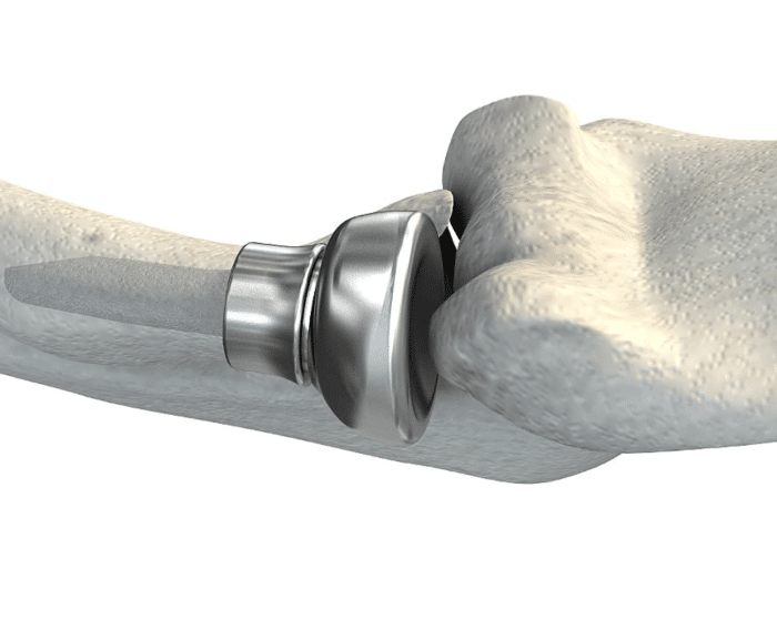 The ArmDoc - Radial head replacement