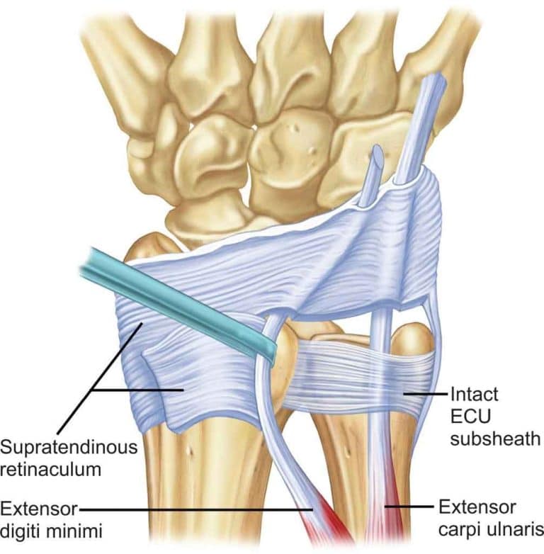 The ArmDoc - Extensor Carpi Ulnaris Subluxation
