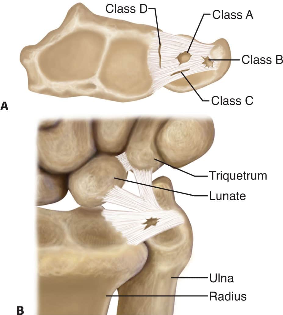The ArmDoc - Arthroscopic and Open Triangular Fibrocartilage Complex Repair