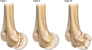 The ArmDoc - Capitellum and Capitellar-Trochlear Shear Fractures