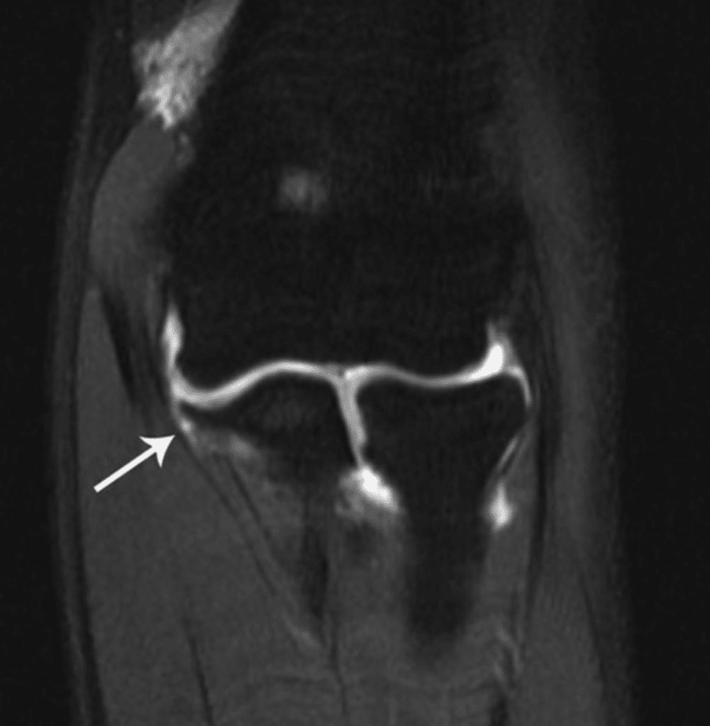 The ArmDoc - Ulnar Collateral Ligament Reconstruction of the Elbow