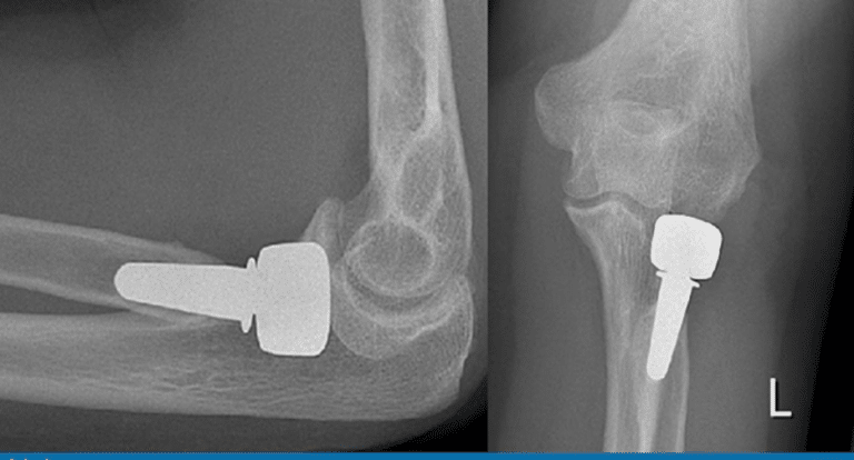 The ArmDoc - Current Advances in Total Elbow Arthroplasty: A ...