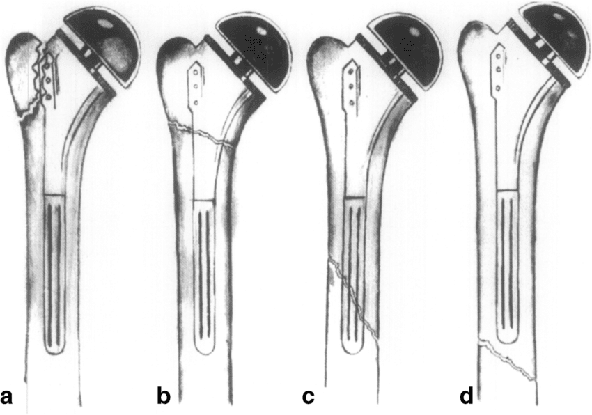 The ArmDoc - Periprosthetic Humeral Fractures