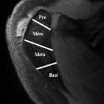 The ArmDoc - Os Acromiale