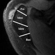 The ArmDoc - Os Acromiale