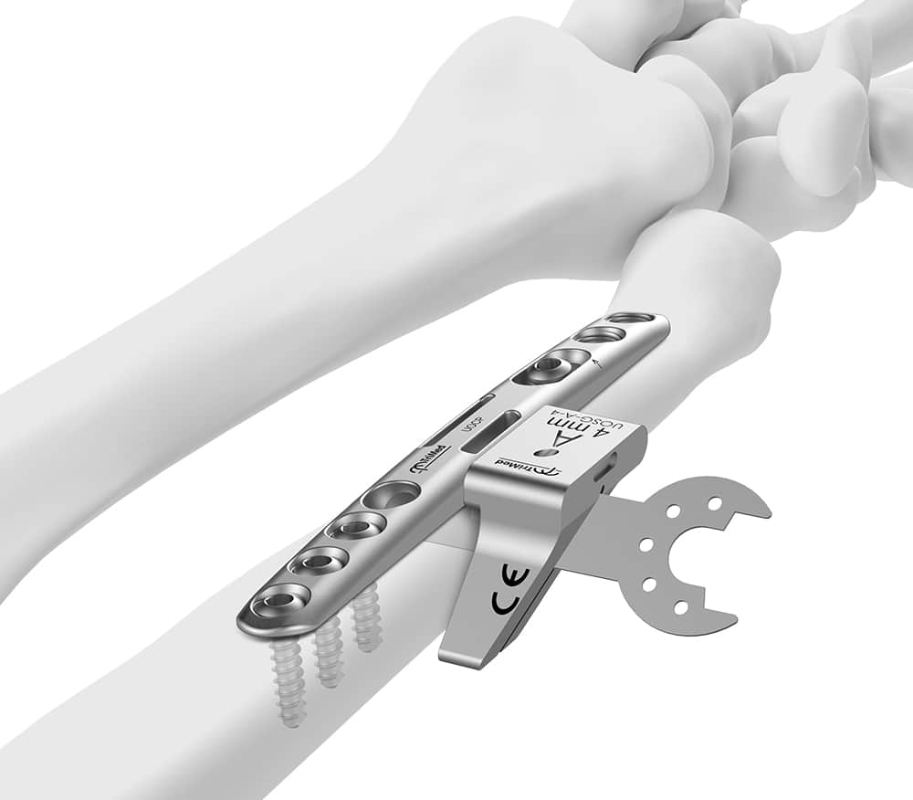 The ArmDoc - Ulnar Shortening Osteotomy