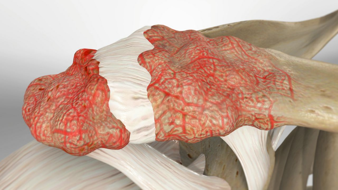 The ArmDoc - AC Joint Osteoarthritis