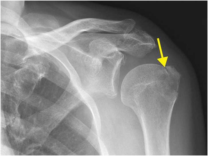 The ArmDoc - Greater Tuberosity Fractures