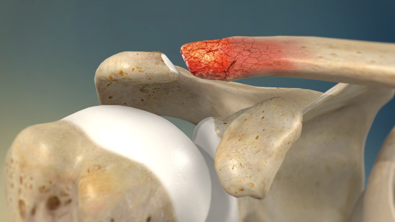 Distal Clavicle Osteolysis