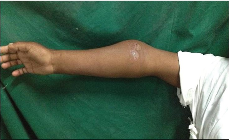 The ArmDoc - Charcot Arthropathy of the Elbow