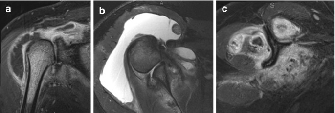 The ArmDoc - Charcot Shoulder (Neuropathic Shoulder)