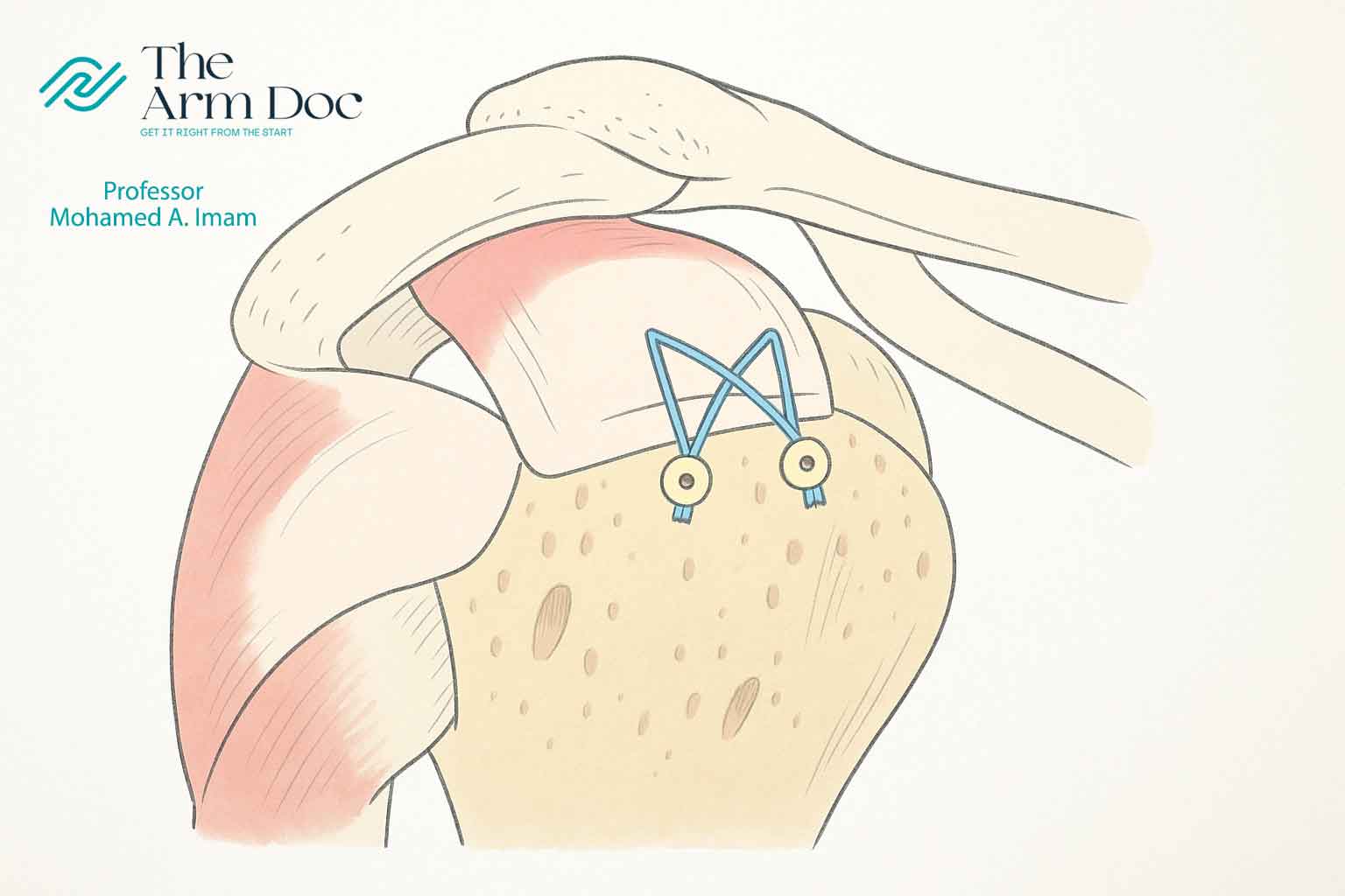 The ArmDoc - Failed Rotator Cuff Repair