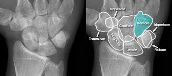 The ArmDoc - Hamate Fractures