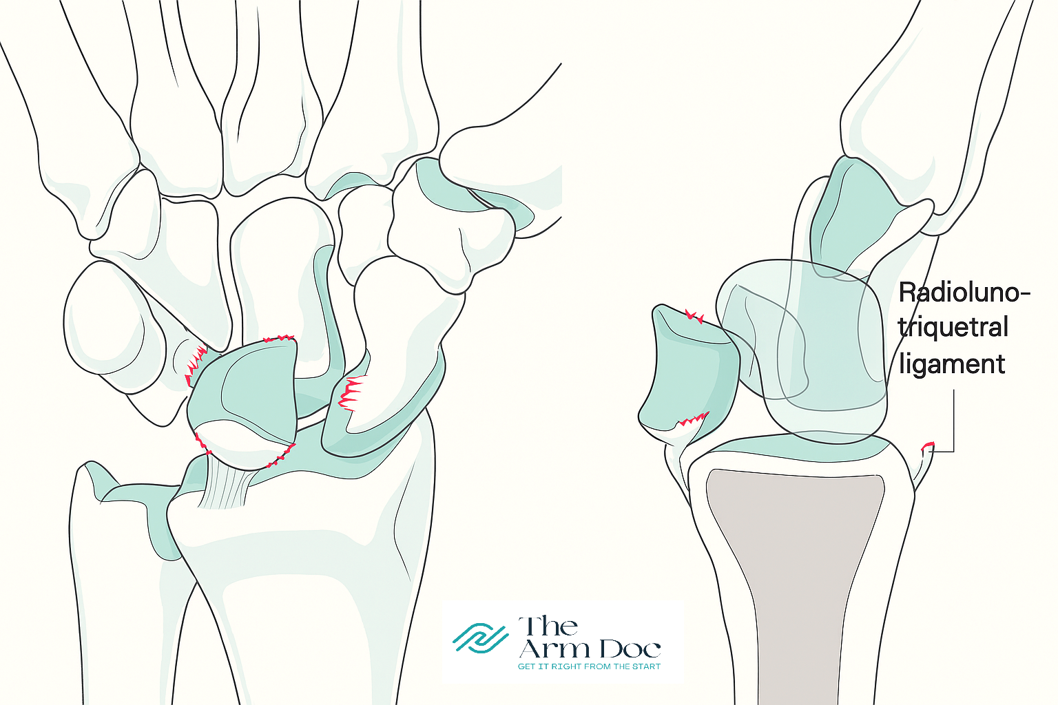 The ArmDoc - Lunate and Perilunate Dislocations