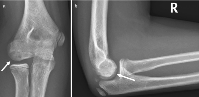 The ArmDoc - Osteochondritis Dissecans of the elbow