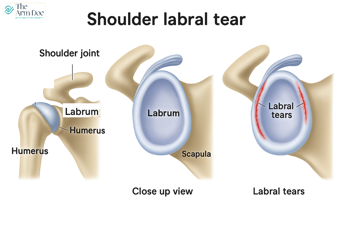 The ArmDoc Posterior Labral Tear