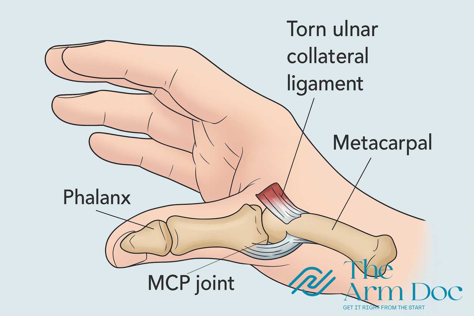 Ucl Ligament Thumb Ulnar Collateral Ligament Ucl Injury