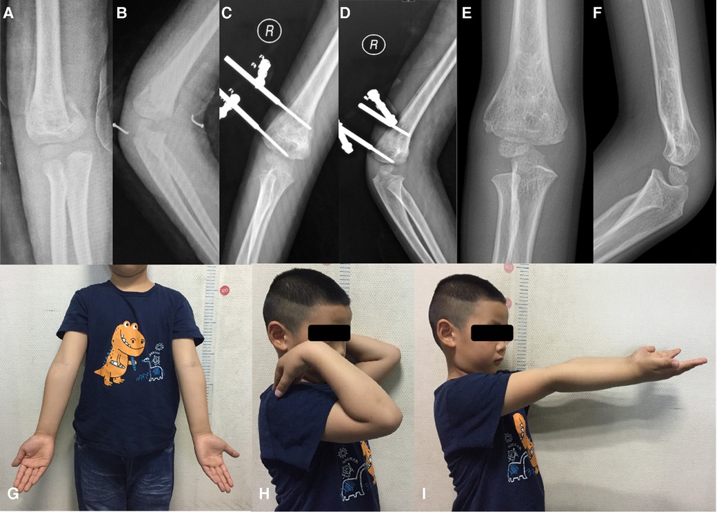 The ArmDoc - Supracondylar Humerus Fractures in Children