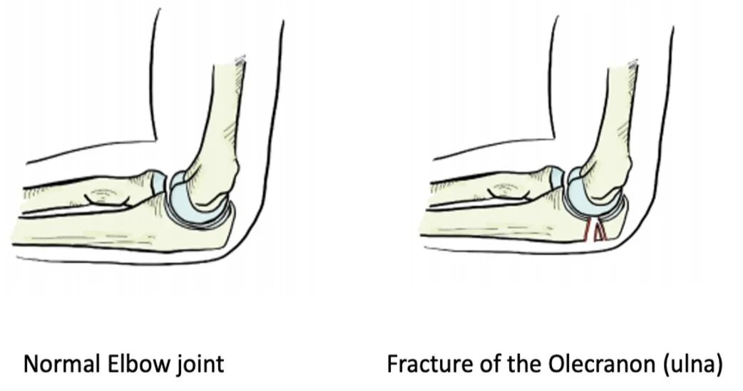The ArmDoc - Olecranon Stress Fracture